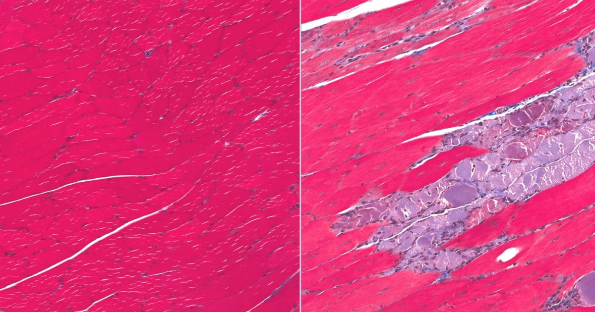 SMA Muscle Breakdown Pathways Differ with Severity in Mouse Study