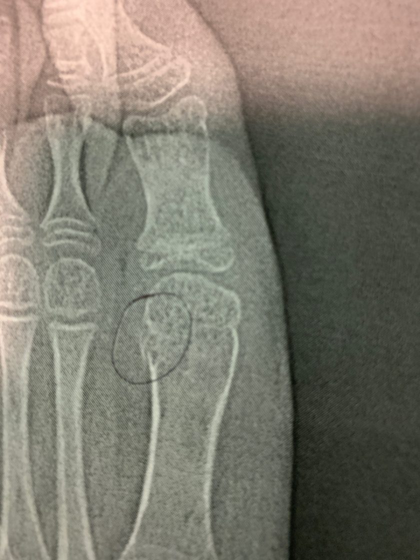 Ella's First Day of School Ends with a Broken Foot | SMA News Today