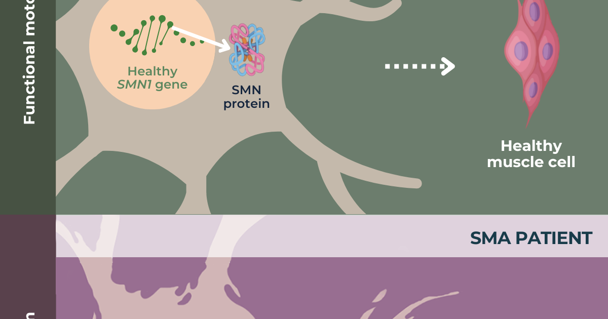 Spinal muscular atrophy (SMA) overview | SMA News Today